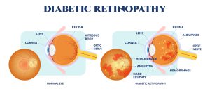 Diabetic Retinopathy – South Carolina Retina Institute LLC