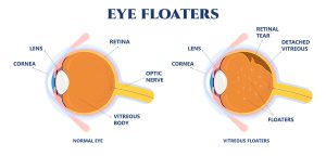 Eye Floaters | South Carolina Retina Institute