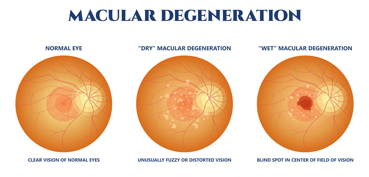 Macular Degeneration Macular Degeneration