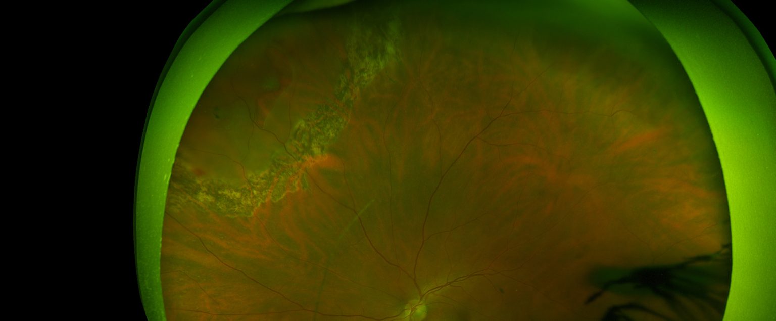 Retinal Detachment | South Carolina Retina Institute