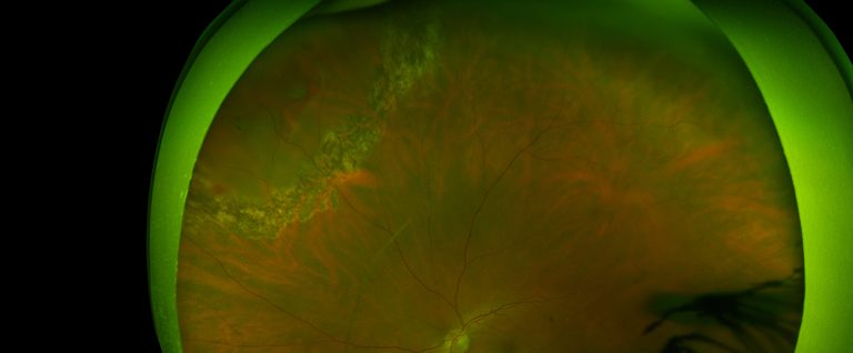 Retinal Detachment | South Carolina Retina Institute